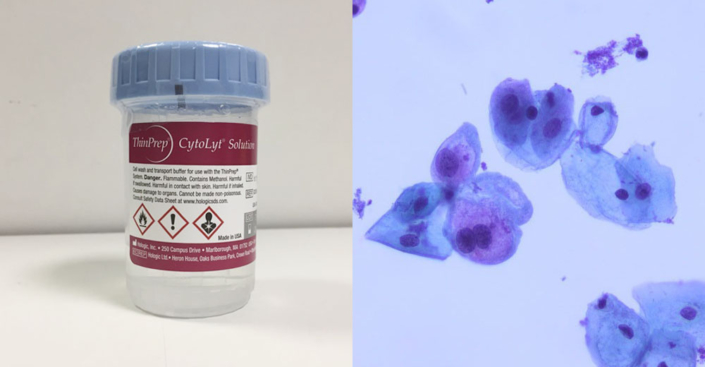 Tumore della vescica: esame citologico su tre campioni di urine